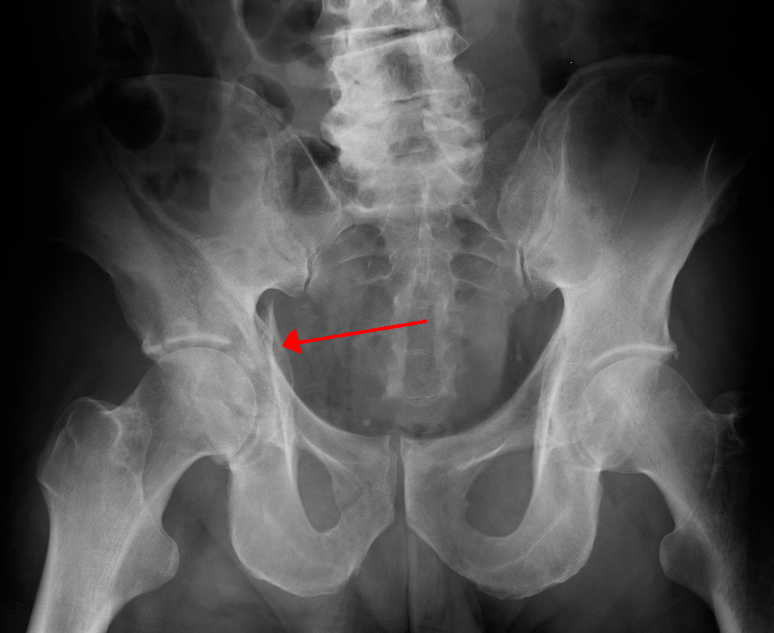 Acetabular Fracture Treatment - Acetabulum Fracture Symptom