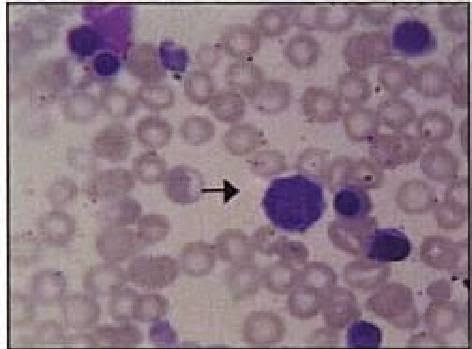 fichero hematologia: Eritroblasto basofilo