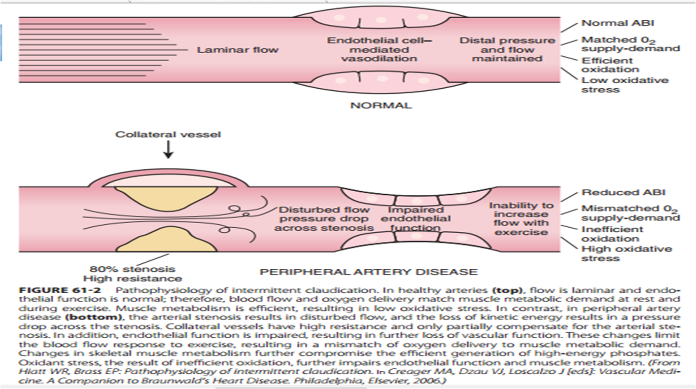 Penyakit Arteri Perifer - CatatanDokter