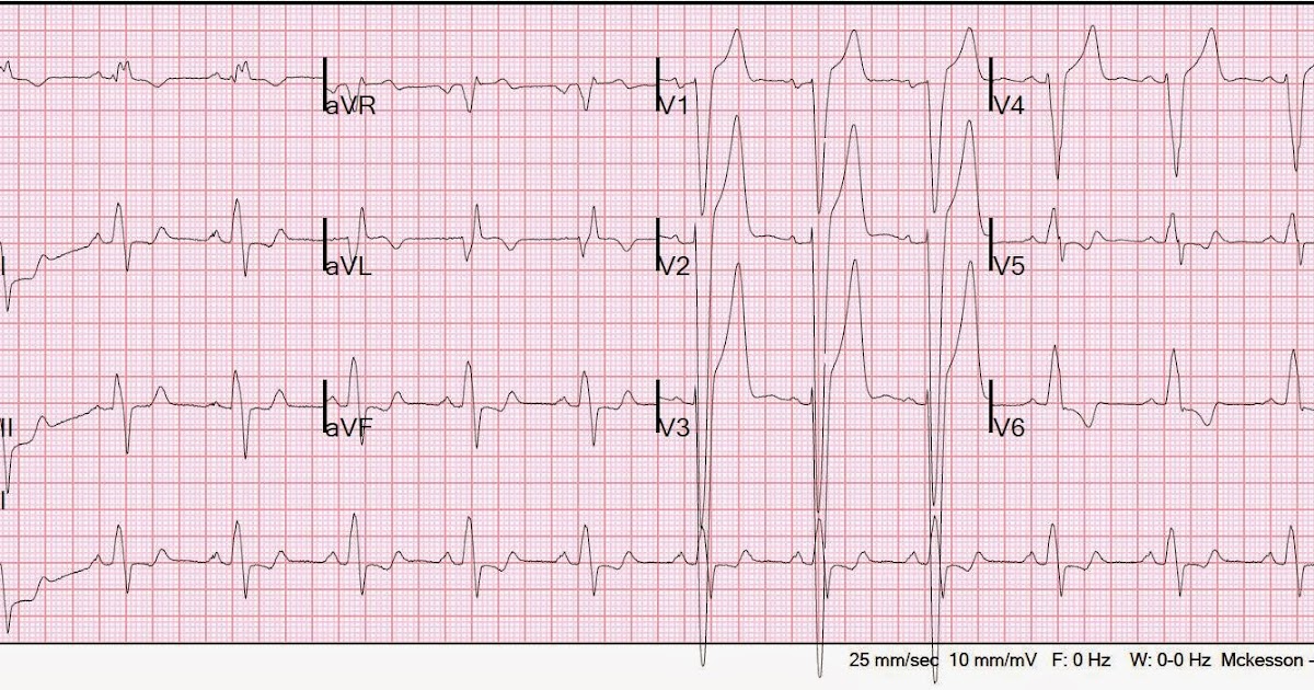 Dr. Smith's ECG Blog: New LBBB and Massive ST elevation: Do not ...