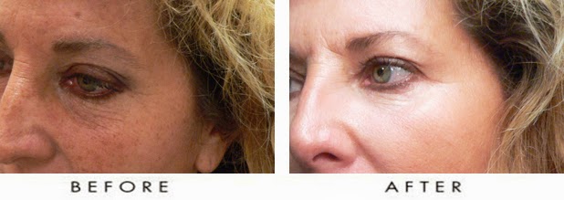 "Kenali “Photoaging” dan Pengobatannya"