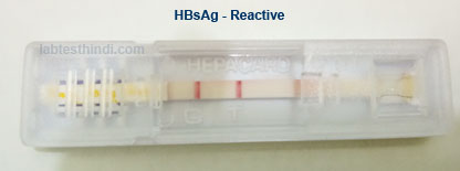 HBsAg Test कैसे करते है ~ Lab Test Hindi