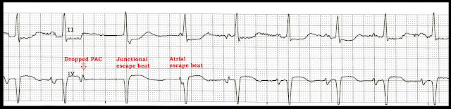 EKG Rhythm Strip Quiz 84