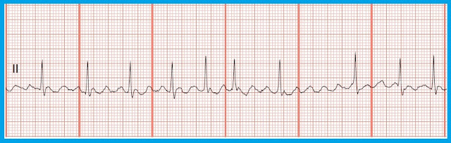 Practice EKG Rhythm Strips 197