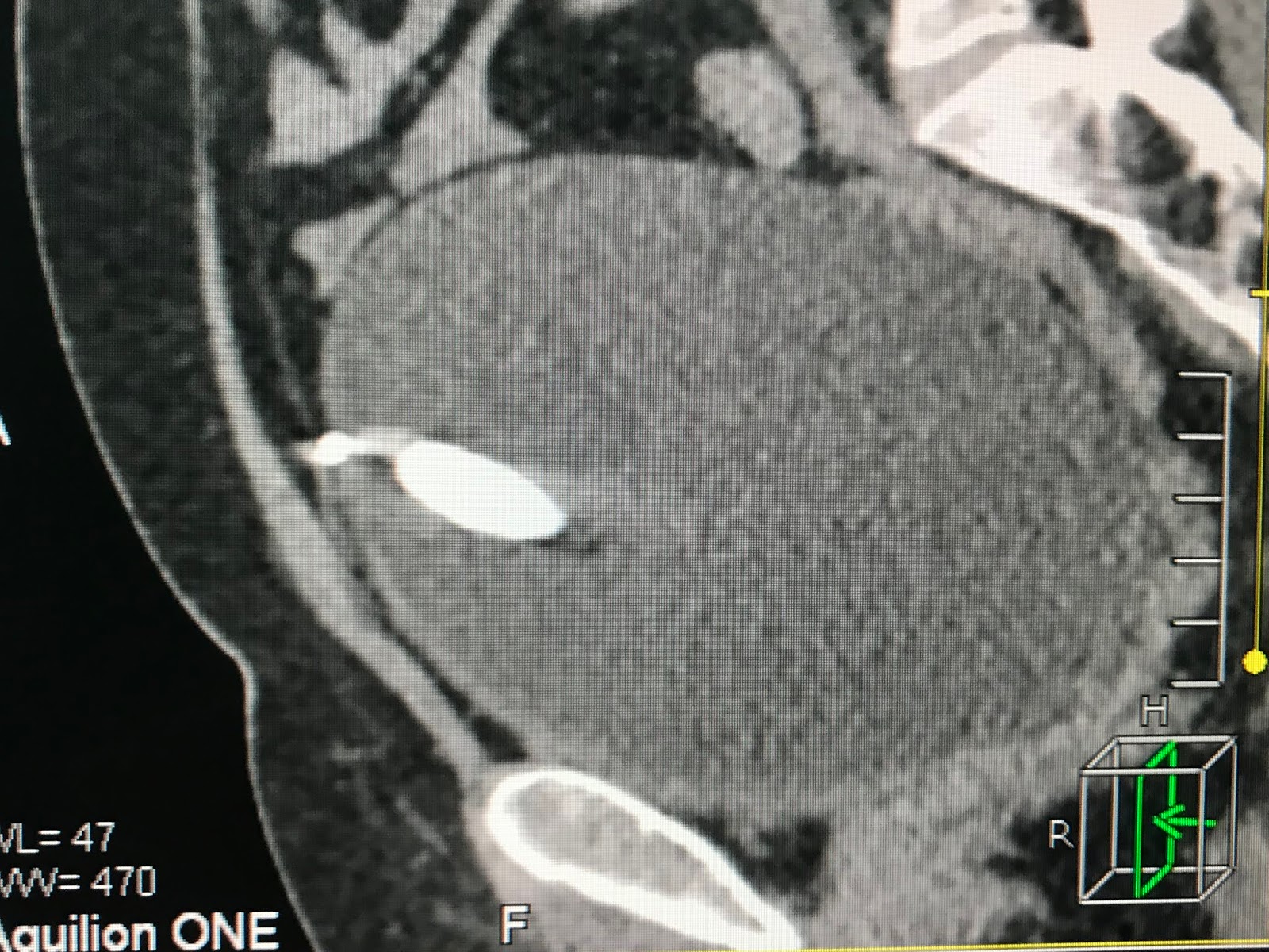 VIETNAMESE MEDIC ULTRASOUND: CASE 514: IUD PENETRATING TO URINARY ...