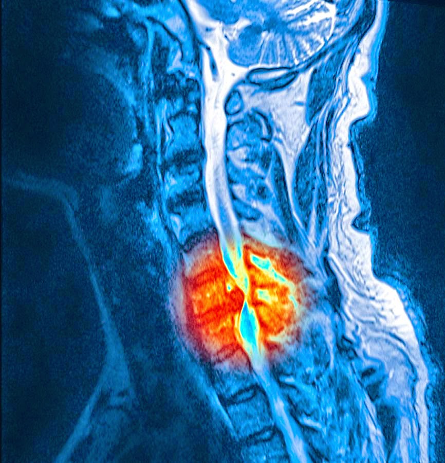 INFO SIHAT: BAHAYA ~ SLIPPED DISC~