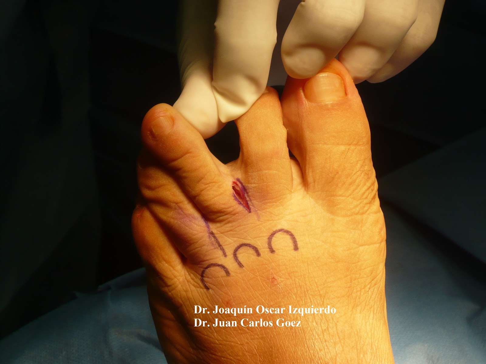 Blog del Dr. Joaquín Oscar Izquierdo: Neuropatias interdigitales