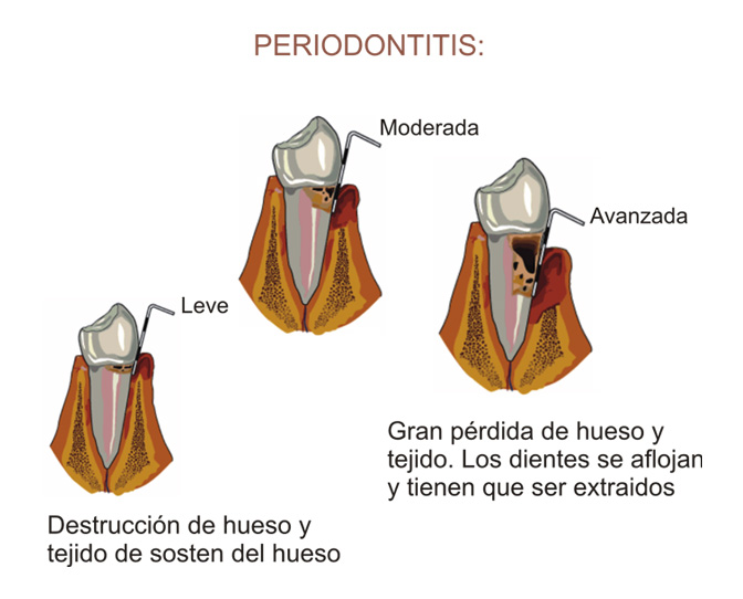 ENFERMEDADES PERIODONTALES: PERIODONTITIS