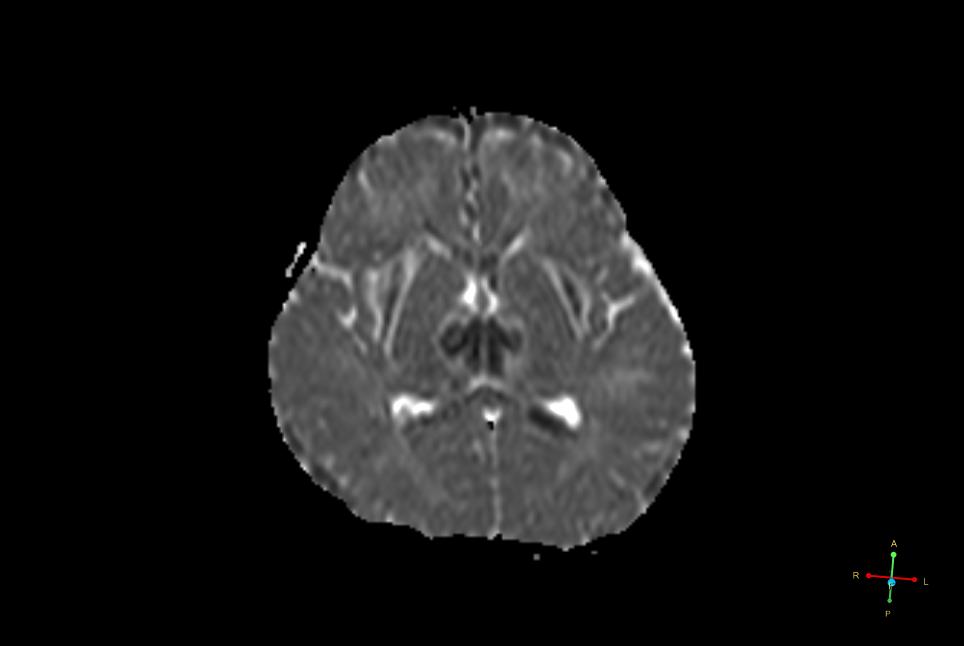 Acute encephalopathy with biphasic seizures & late reduced diffusion ...