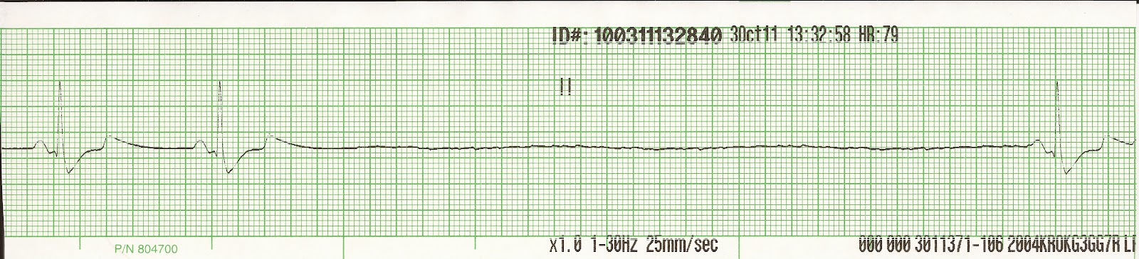 EKG Rhythm Strips 08