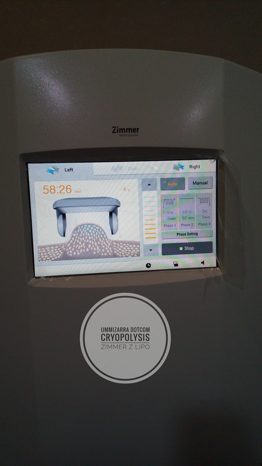 BUANG LEMAK TANPA RASA SAKIT DENGAN ZIMMER Z LIPO DAN Z WAVE