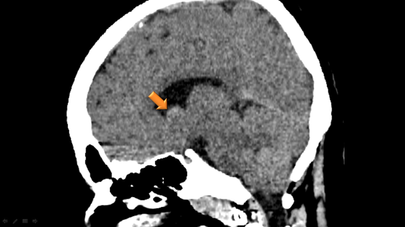 Ultimate Radiology : Plain CT Brain findings in an adolescent patient ...