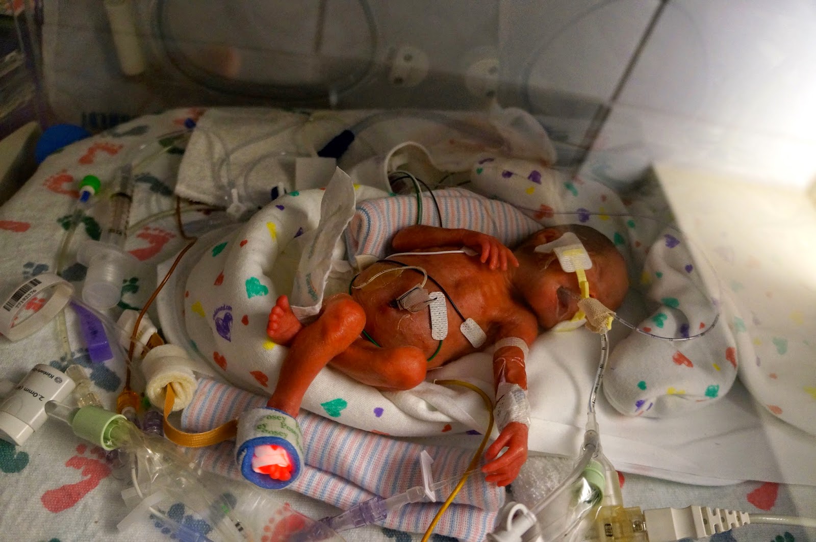 Helmkamp Family: No more umbilical lines