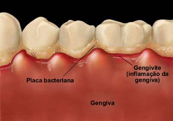 GENGIVITE TEM CURA? TRATAMENTO ~ Dicas Grátis 2020