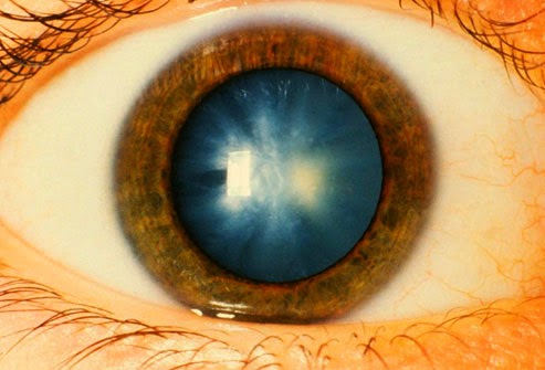 Mengenal 3 Tipe Katarak | Informasi, Tips dan Artikel Seputar Kesehatan