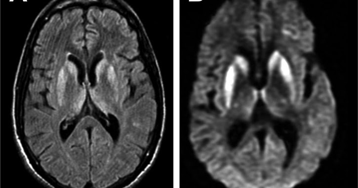 Eaton Rapids Joe: Prions and Chronic Wasting Disease in Deer