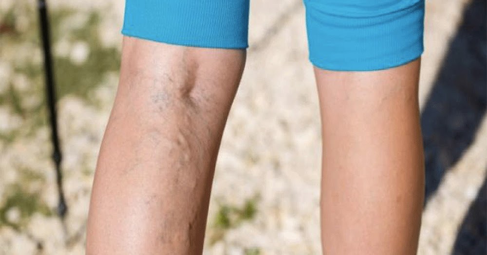 Penyakit Varises Adalah - Homecare24