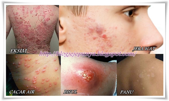 Gejala Awal Penyakit Infeksi Kulit ~ Jeje Punya