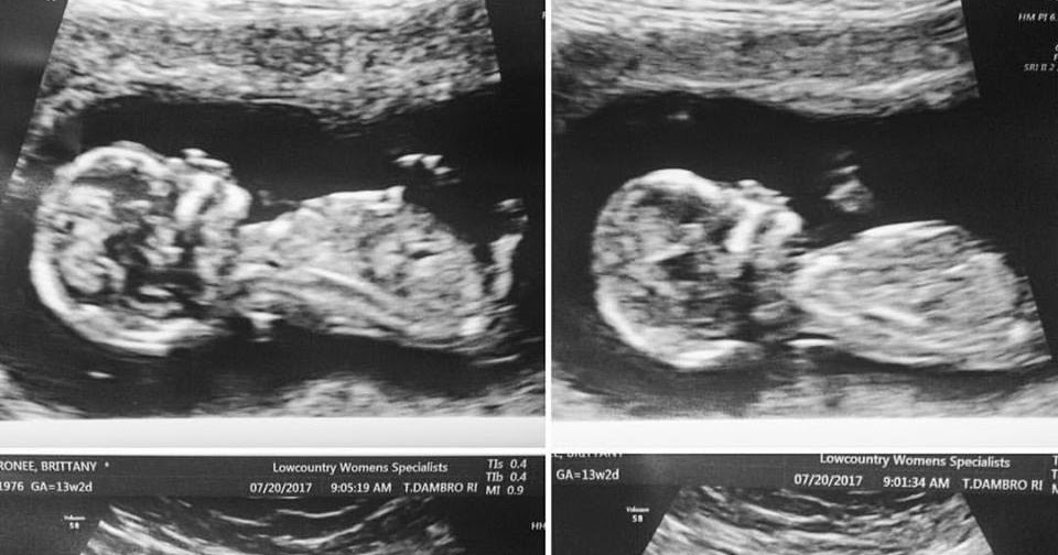 Oh Baby V!: 13 week NT ultrasound
