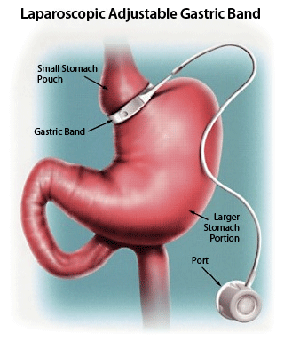 Blossom Bariatrics: A Beginner's Guide to Bariatric Surgery (Part One)