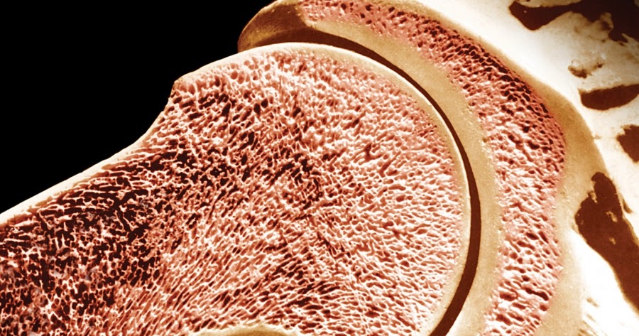 Cancer nos ossos - Sintomas de cancer nos ossos - Chondrosarcoma ...