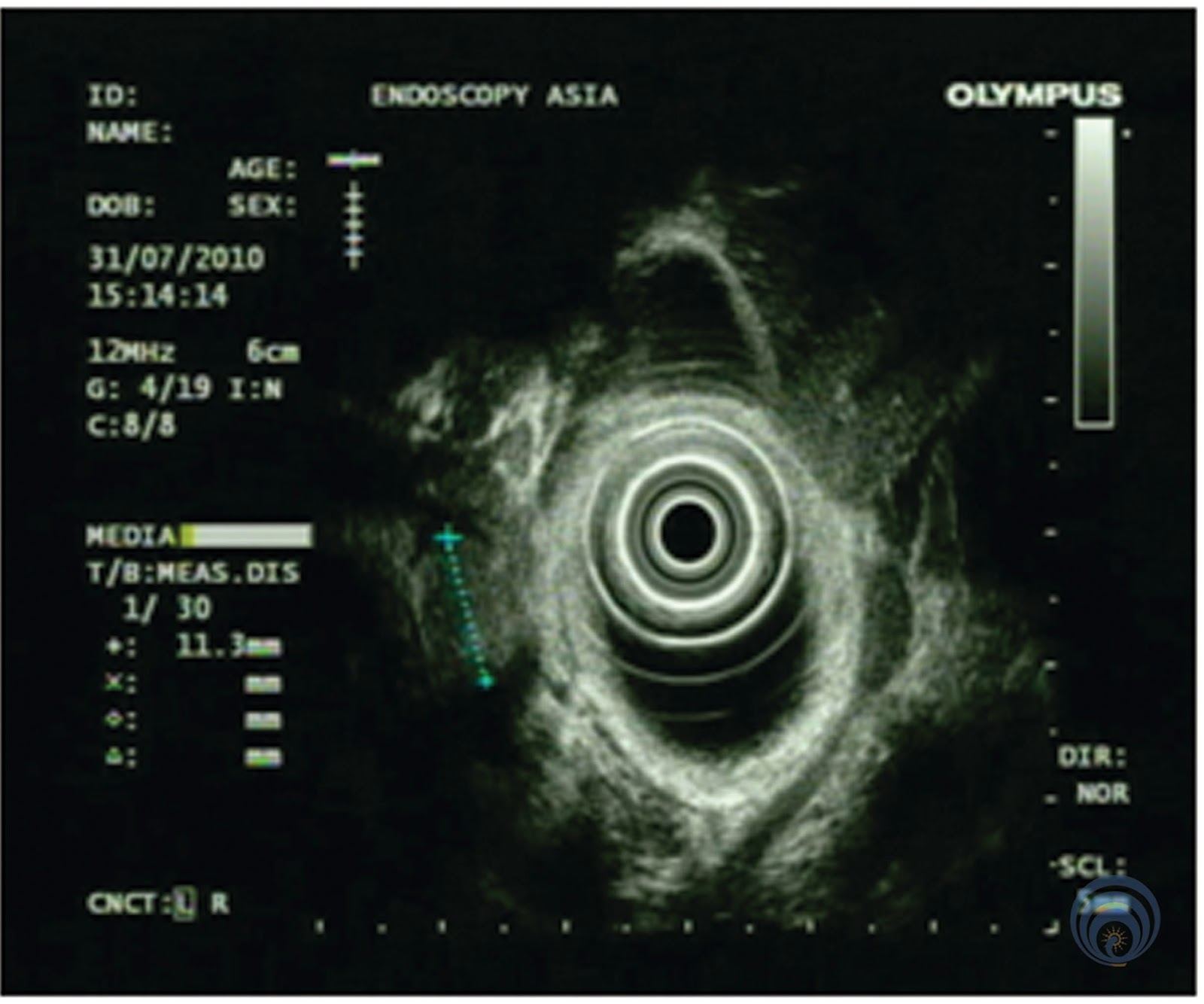 Endoscopy Asia Blog: Endoscopy Asia successfully treats a patient ...