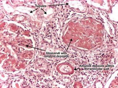 MEDICAL CHOICES: Histology and Explanation of Amyloidosis kidney