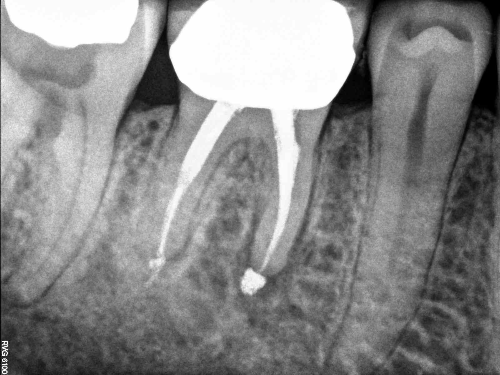 Root Canal Lower Molar First - 65 WM - Bauer Smiles