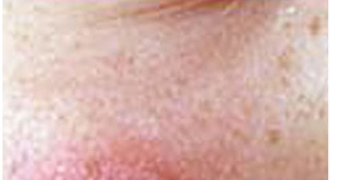 LAPORAN PENDAHULUAN ASUHAN KEPERAWATAN ABSES | Asuhan Keperawatan