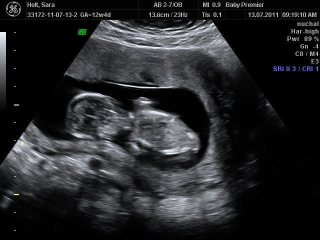 Pregnant with MS: 12 Week scan!