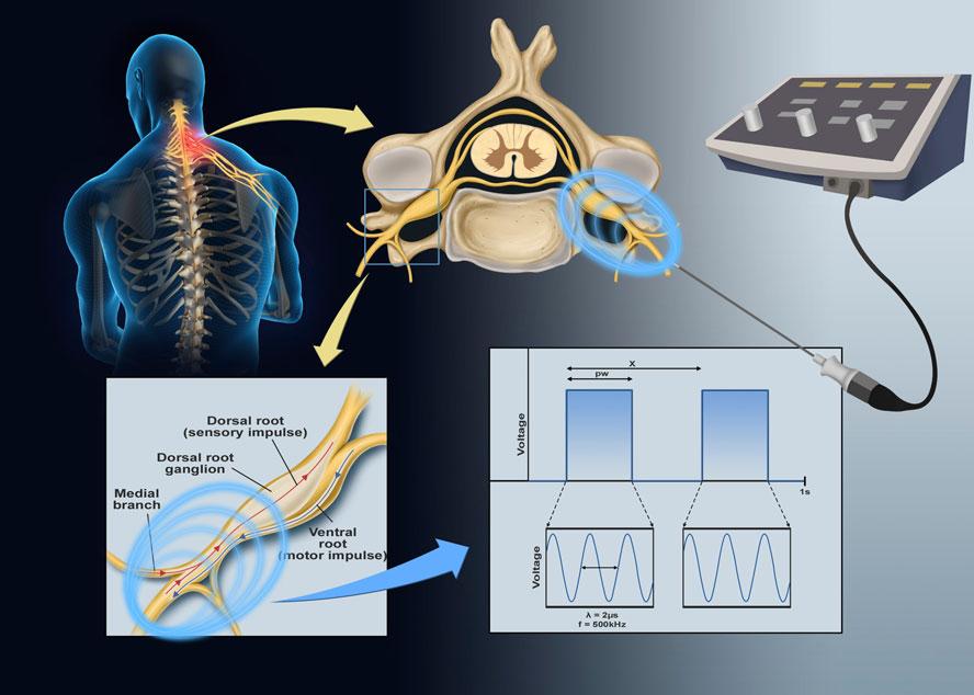 MEDICAL ISSUE: Erectile Dysfunction: DIAGNOSIS - Penile biothesiometry