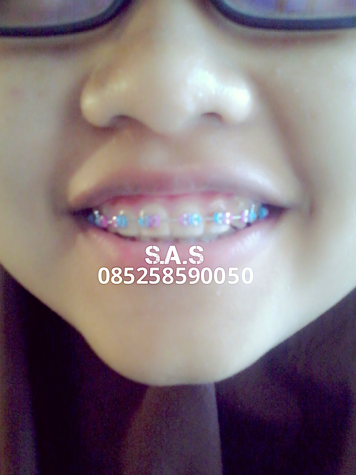 Koleksi Foto Senyum Behel Cantik dan Model Warna Karet Behel :) |Tukang ...