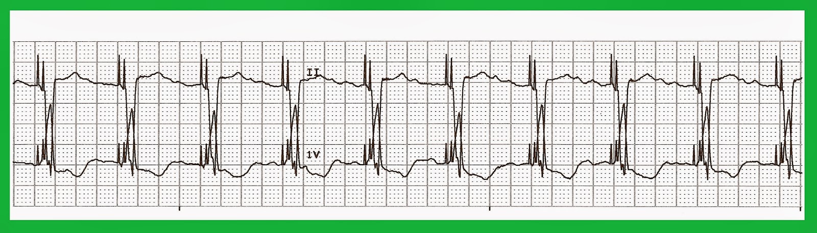 Float Nurse: Various Biventricular Paced Rhythms