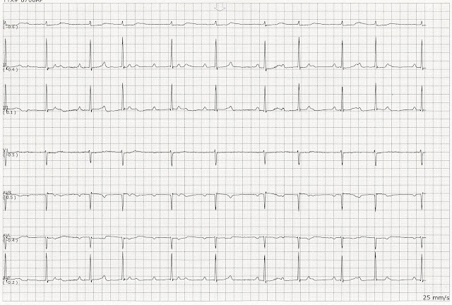 Complete heart block.