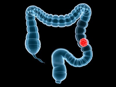 5 Priority Nursing Diagnosis for Colon Cancer - NANDA - Nursing Diagnosis