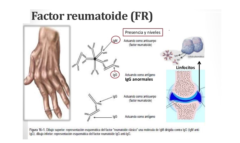SyM Clínica Ocupacional y Asistencial S.A.C: ¿Qué es el factor reumatoideo?