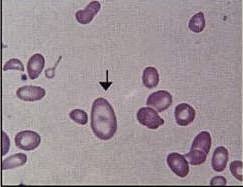 fichero hematologia: Ovalocito