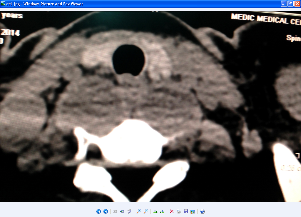 VIETNAMESE MEDIC ULTRASOUND: CASE 290: PARACERVICAL SPINE ABSCESS: Dr ...