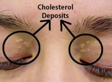 Healthy Eating: HOW TO REMOVE THE CHOLESTEROL DEPOSITS AROUND YOUR EYES