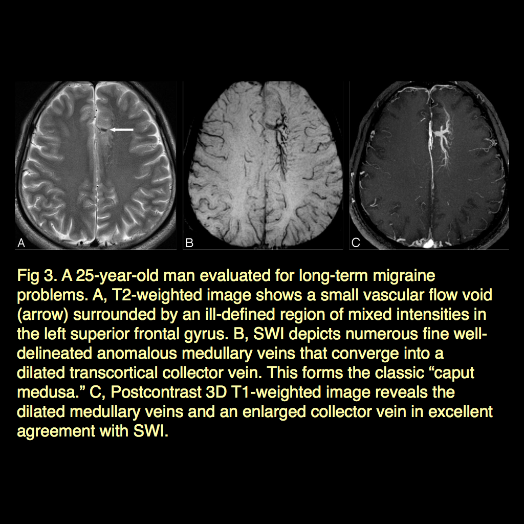 MRI BLOG: Susceptibility Weighted Imaging (II/II) - Image Gallery