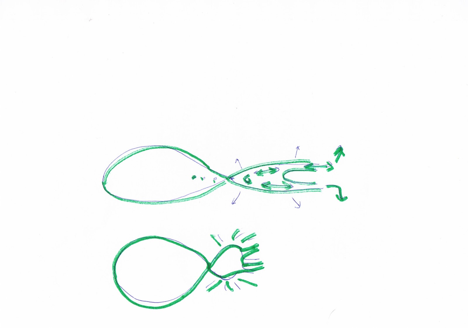 hourglass gallbladder