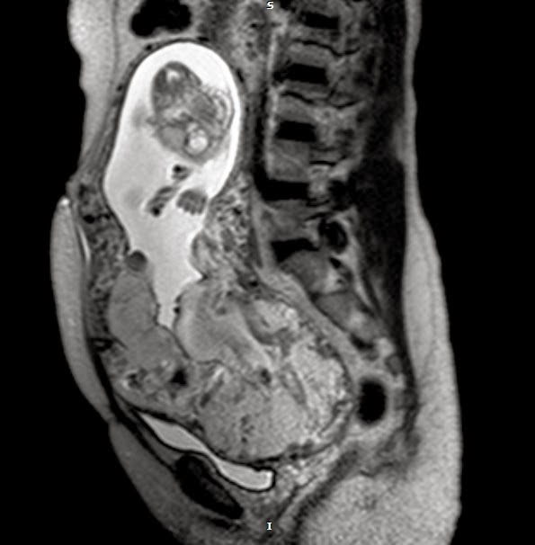 Placenta Increta: MRI - Sumer's Radiology Blog