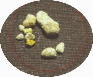 Mei 2014 | Pengobatan Kencing Batu Tanpa Operasi