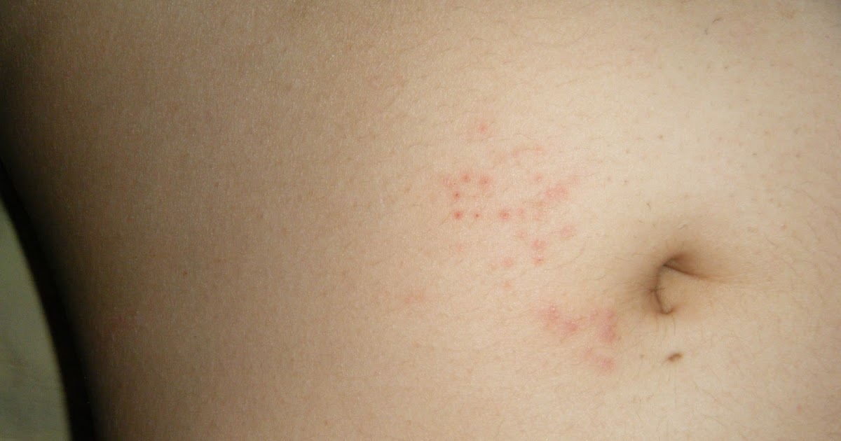 21 and Shingles: DAY 10: still waiting....