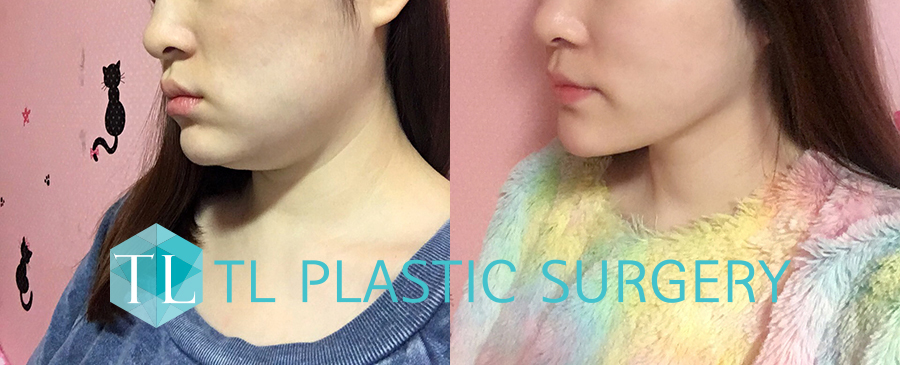 Face and Buccal Fat Cheek Lipo for Double Chin and Jowls - TL ANTI ...