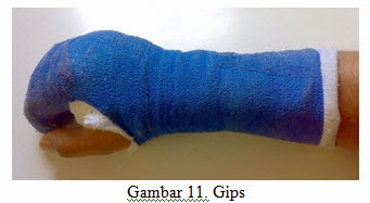 LAPORAN PENDAHULUAN FRAKTUR ANTEBRACHII