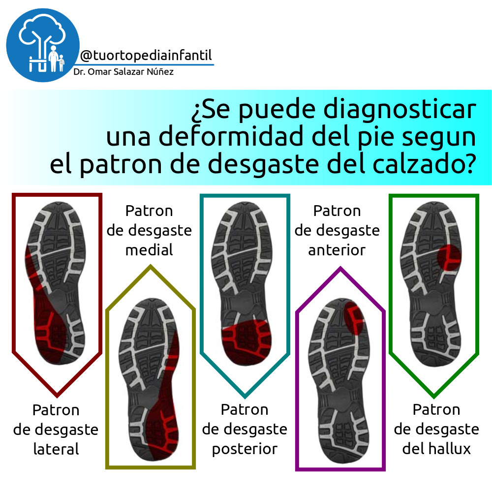 ¿Se puede diagnosticar una deformidad del pie según el patrón del ...