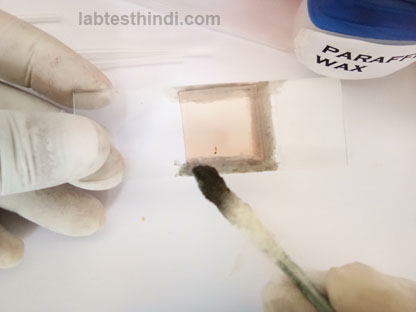 Sickle Cell क्या है | Sickling Test कैसे करते है – ( Slide Method ...