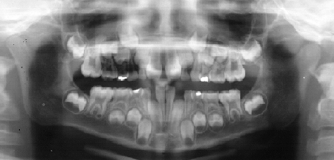 Lakes Park Children's Dentistry & Orthodontics: How Safe Are Dental X-Rays?