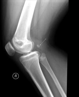 ABC Radiology Blog: Fabella